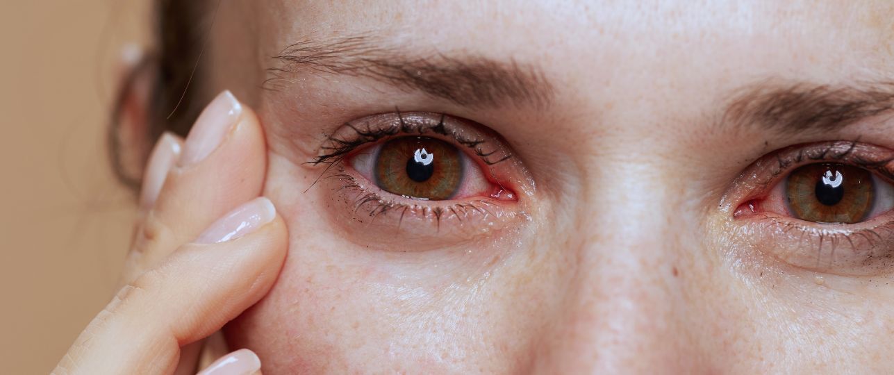Gele puntjes, rode adertjes en vlekjes in je oogwit is dit ernstig?