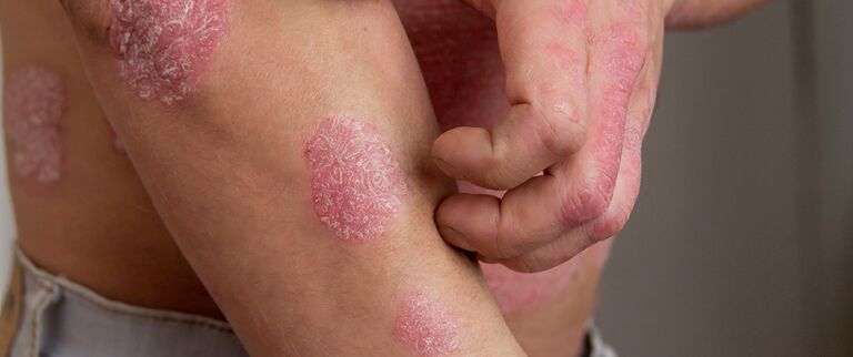Psoriasis, wat houdt de huidziekte in?