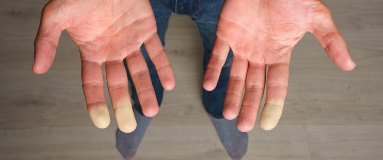 Snel last van witte vingers of witte tenen in de winter, hoe komt dit?